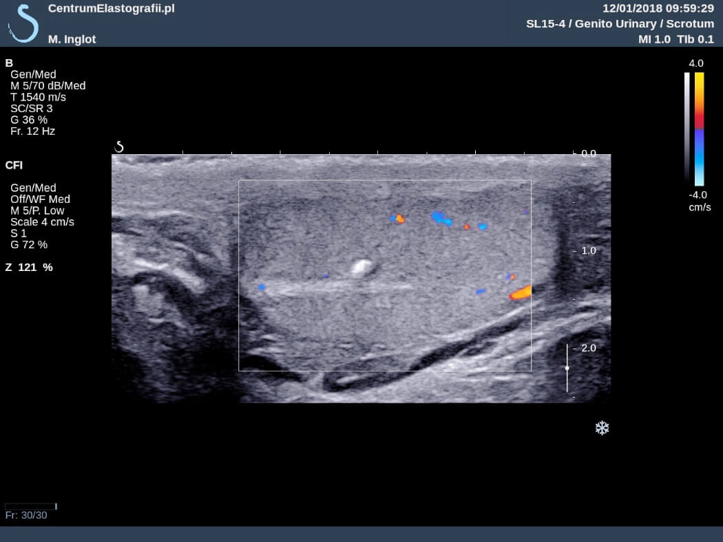 USG Jąder i Moszny Wrocław - Badanie, Wskazania, Przebieg, Wyniki ...