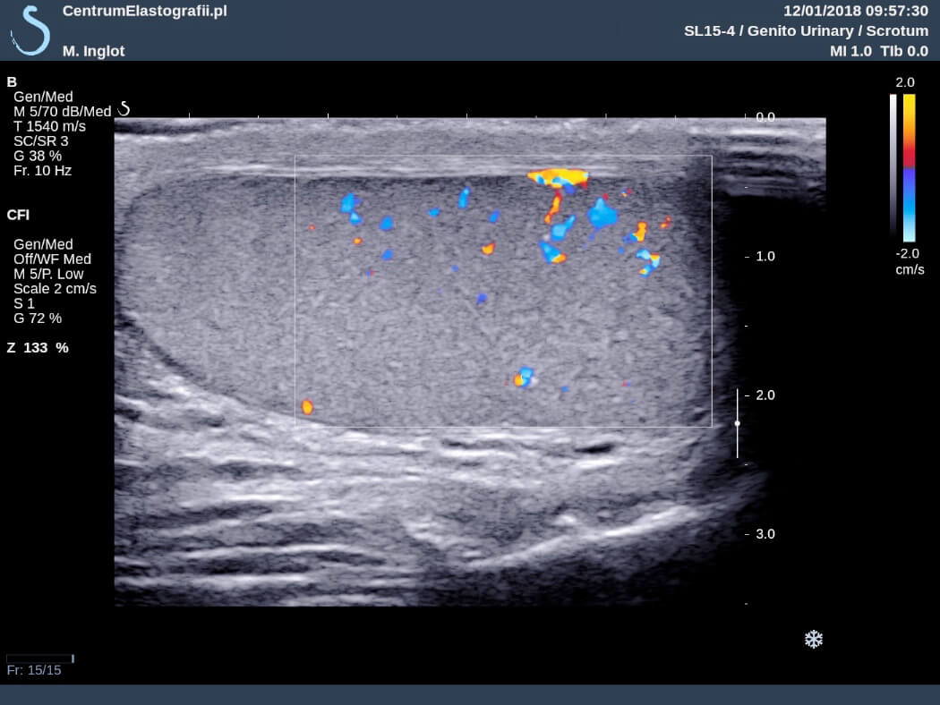 USG Jąder i Moszny Wrocław - Badanie, Wskazania, Przebieg, Wyniki ...